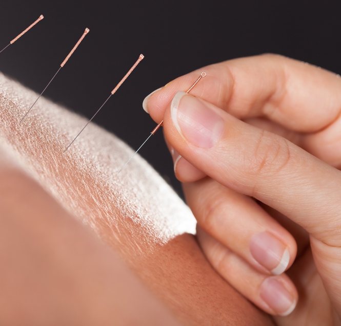 WIN a free acupuncture consultation and treatment worth £90 | The ...